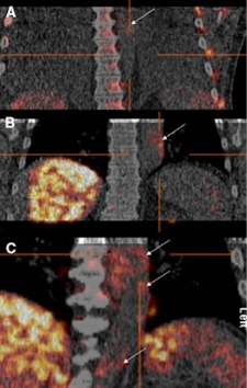 FDG-PET/CT viability scans detect vulnerable aortic plaque | AuntMinnie