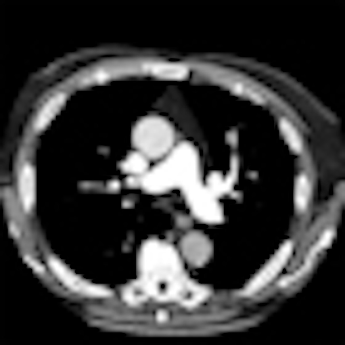 Automated PE protocol tool optimizes contrast use, image quality ...