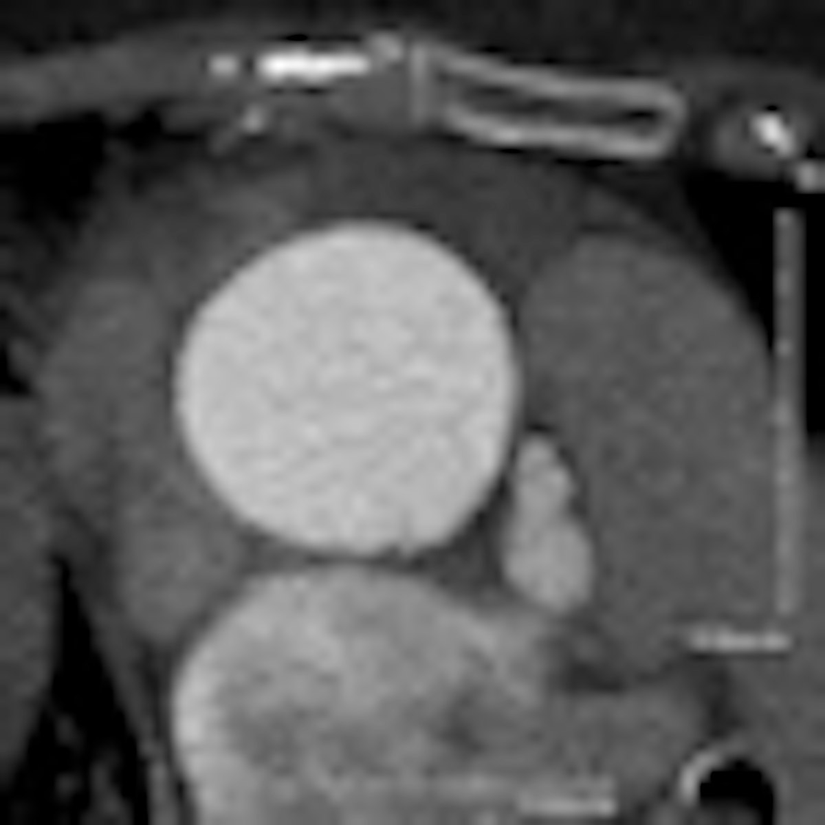 CT limited for detection of subtle aortic tears | AuntMinnie