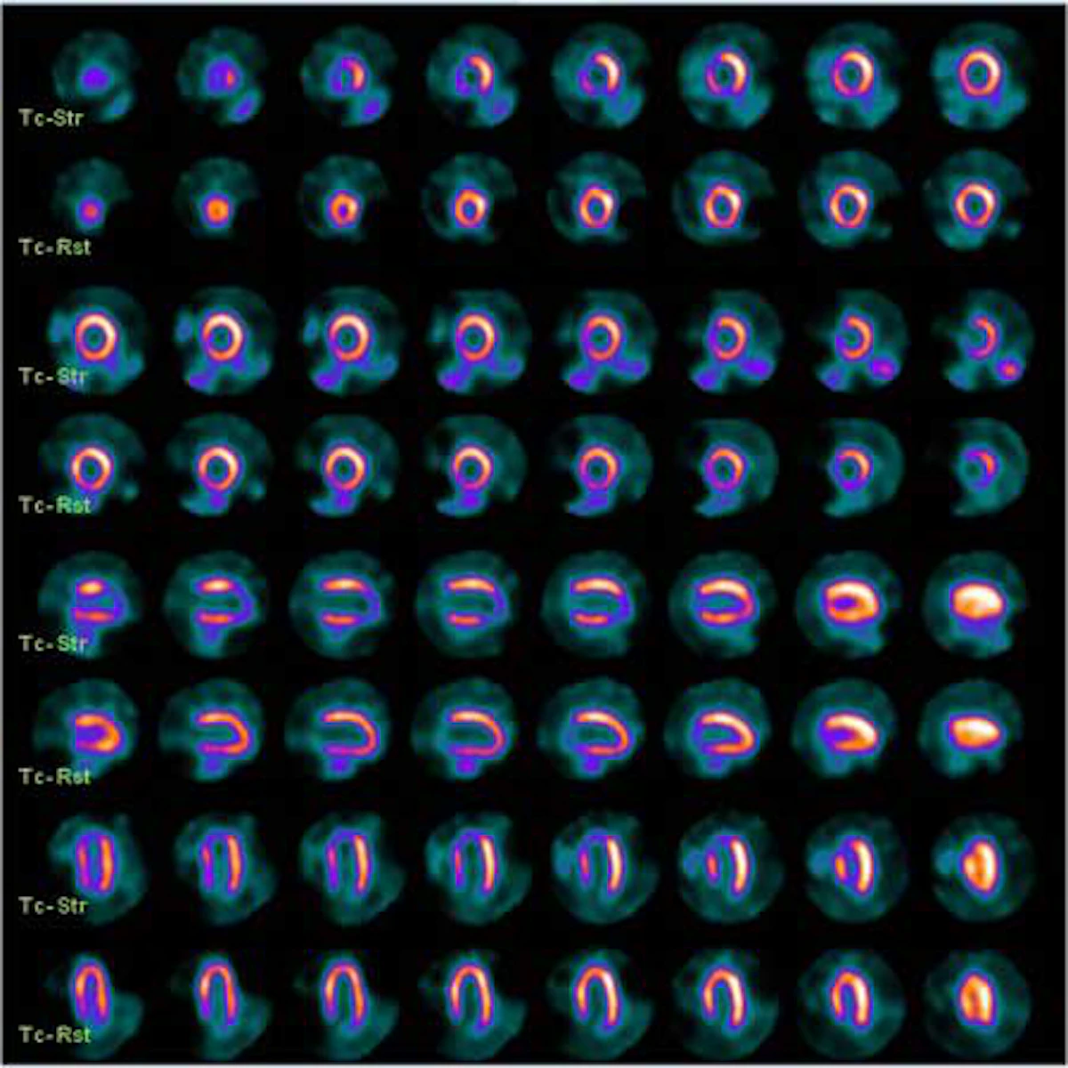 Hardware, software advances spark cardiac SPECT progress | AuntMinnie