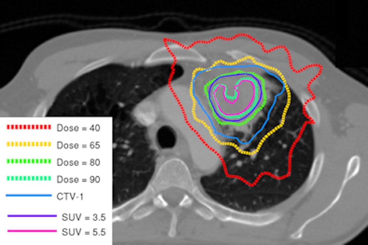 PET/CT helps target radiation therapy of NSCLC tumors | AuntMinnie