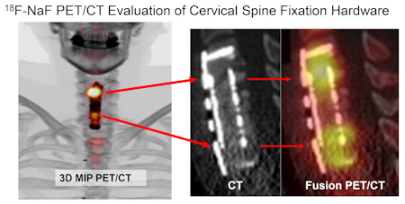 PET/CT with NaF bone agent takes SNM's Image of the Year | AuntMinnie