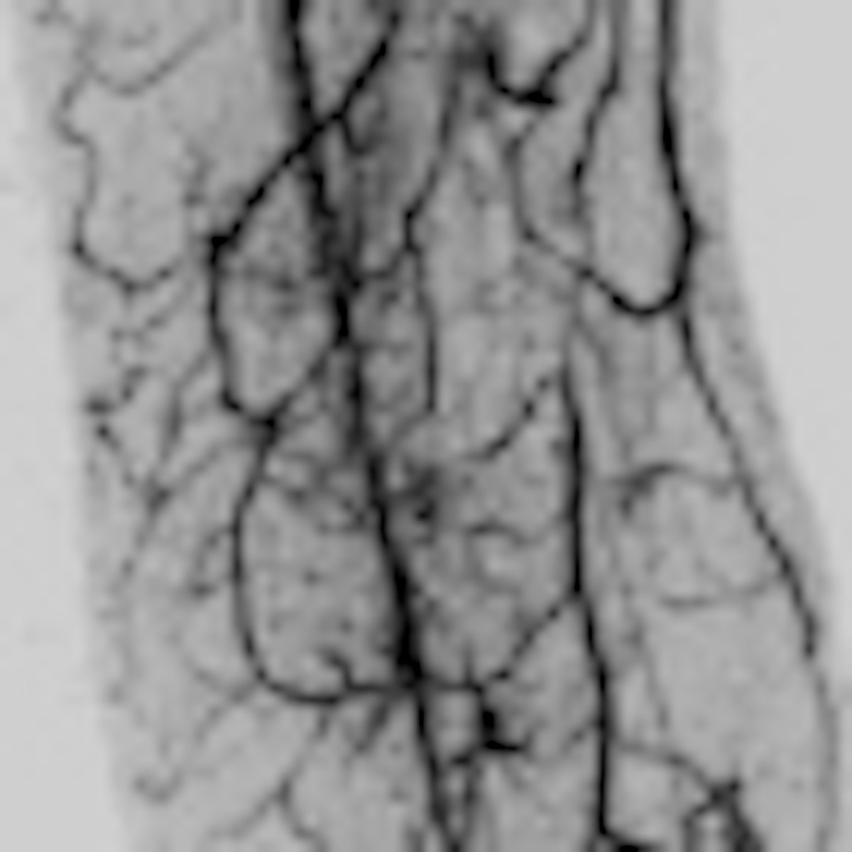CAPR-MRA outperforms CTA in lower extremity vascular imaging | AuntMinnie