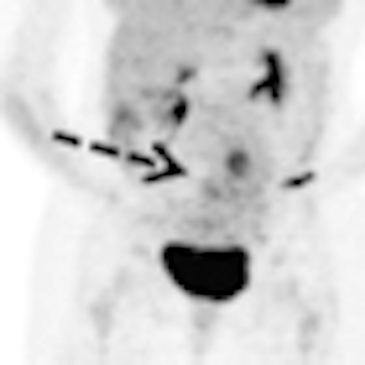 FDG-PET has low radiation risk to fetus in pregnant patients | AuntMinnie