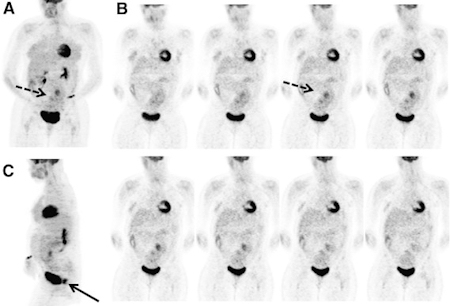 FDG-PET has low radiation risk to fetus in pregnant patients | AuntMinnie
