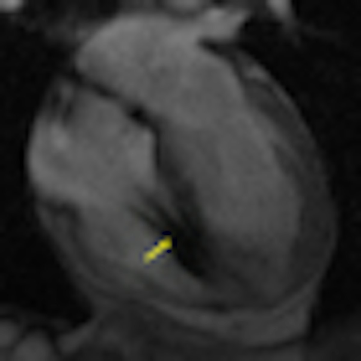 Protocols ensure MRI safety for cardiac device patients | AuntMinnie