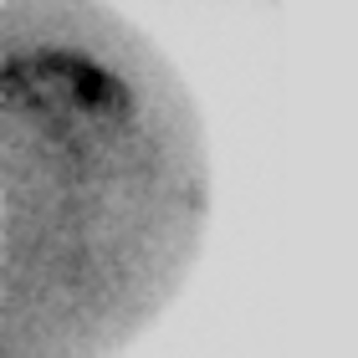 BSGI equals MRI as an adjunct in breast cancer cases | AuntMinnie