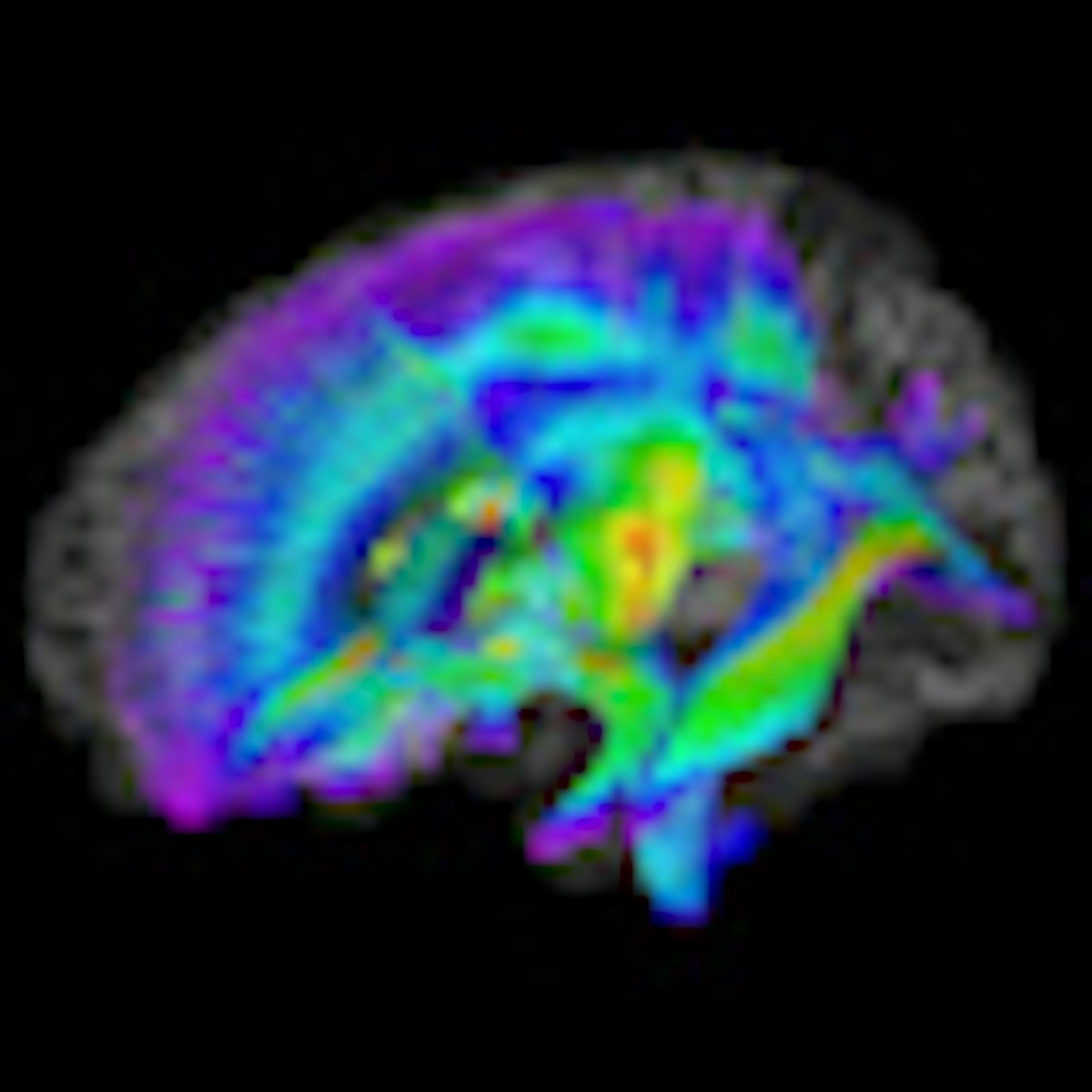 DTI-MRI shows brain differences in infants who develop autism | AuntMinnie