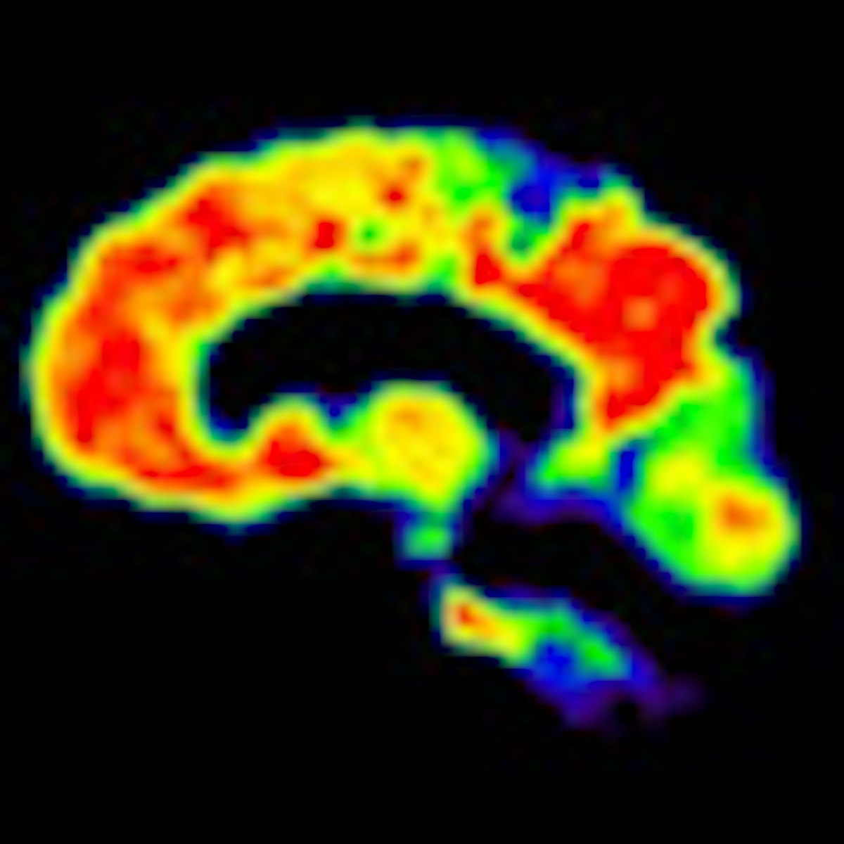 PiB, FDG-PET change diagnosis for dementia patients | AuntMinnie