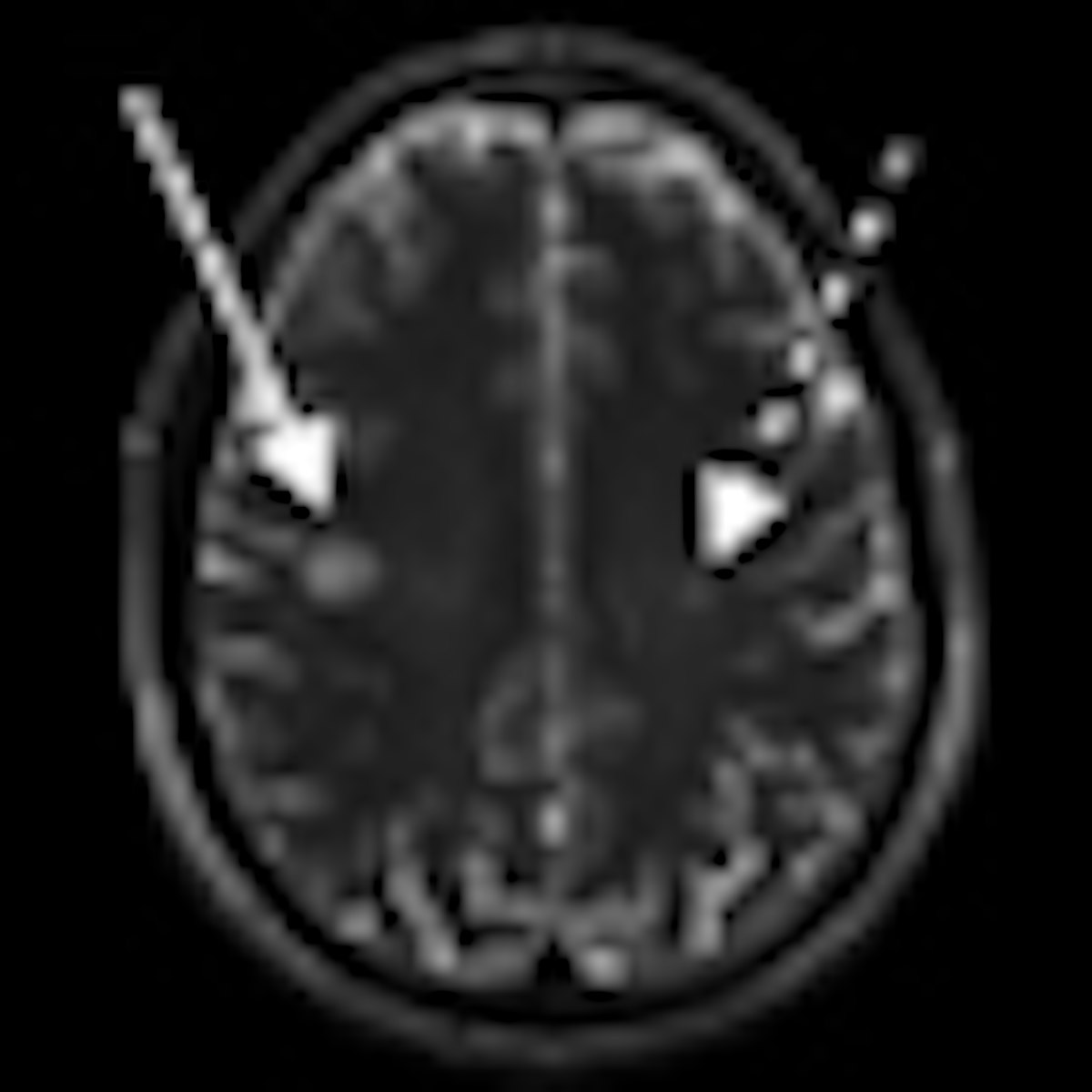 Sodium MRI shows abnormal brain regions in early-stage MS | AuntMinnie