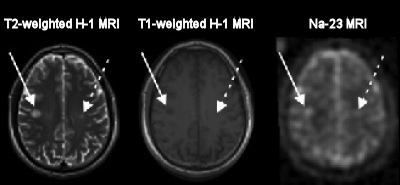 Sodium MRI shows abnormal brain regions in early-stage MS | AuntMinnie