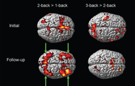 fMRI shows brain changes in patients with mild brain injury | AuntMinnie