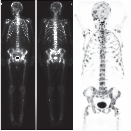 NaF-PET/CT detects bone mets in prostate cancer patients | AuntMinnie