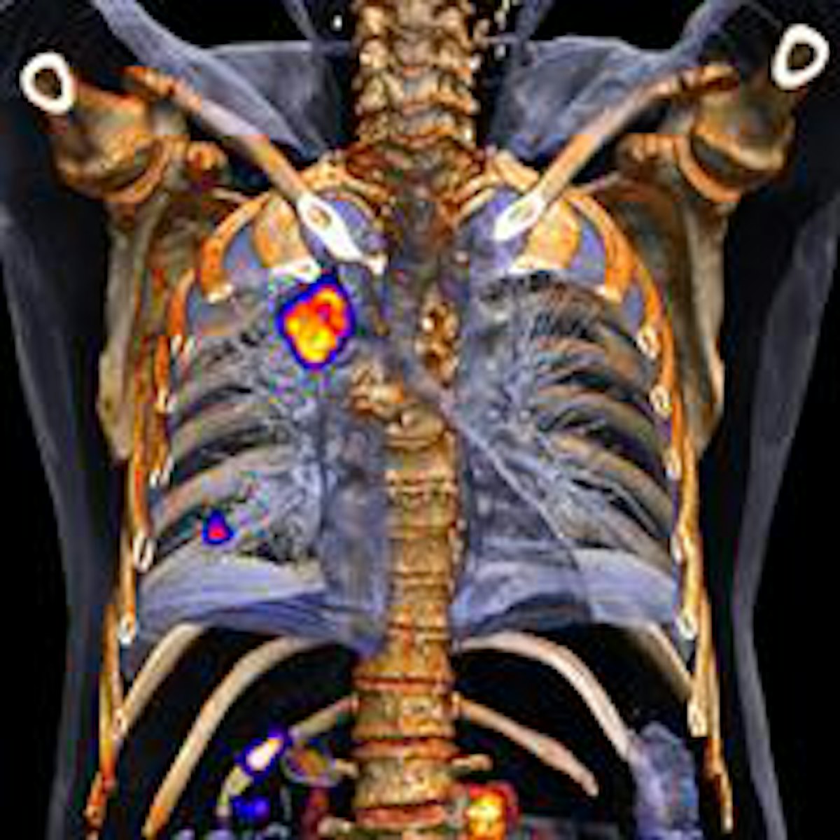 Siemens introduces new Biograph mCT Flow PET/CT | AuntMinnie