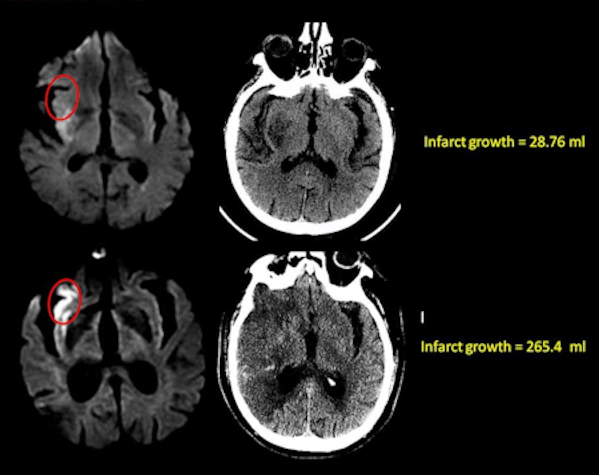 insular cortex ct