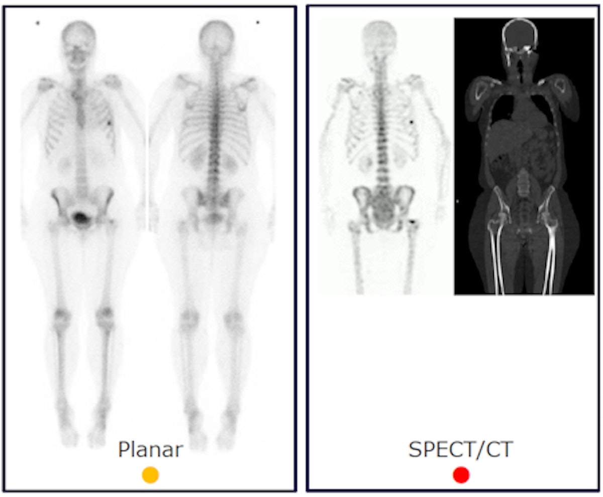 spect bone scan