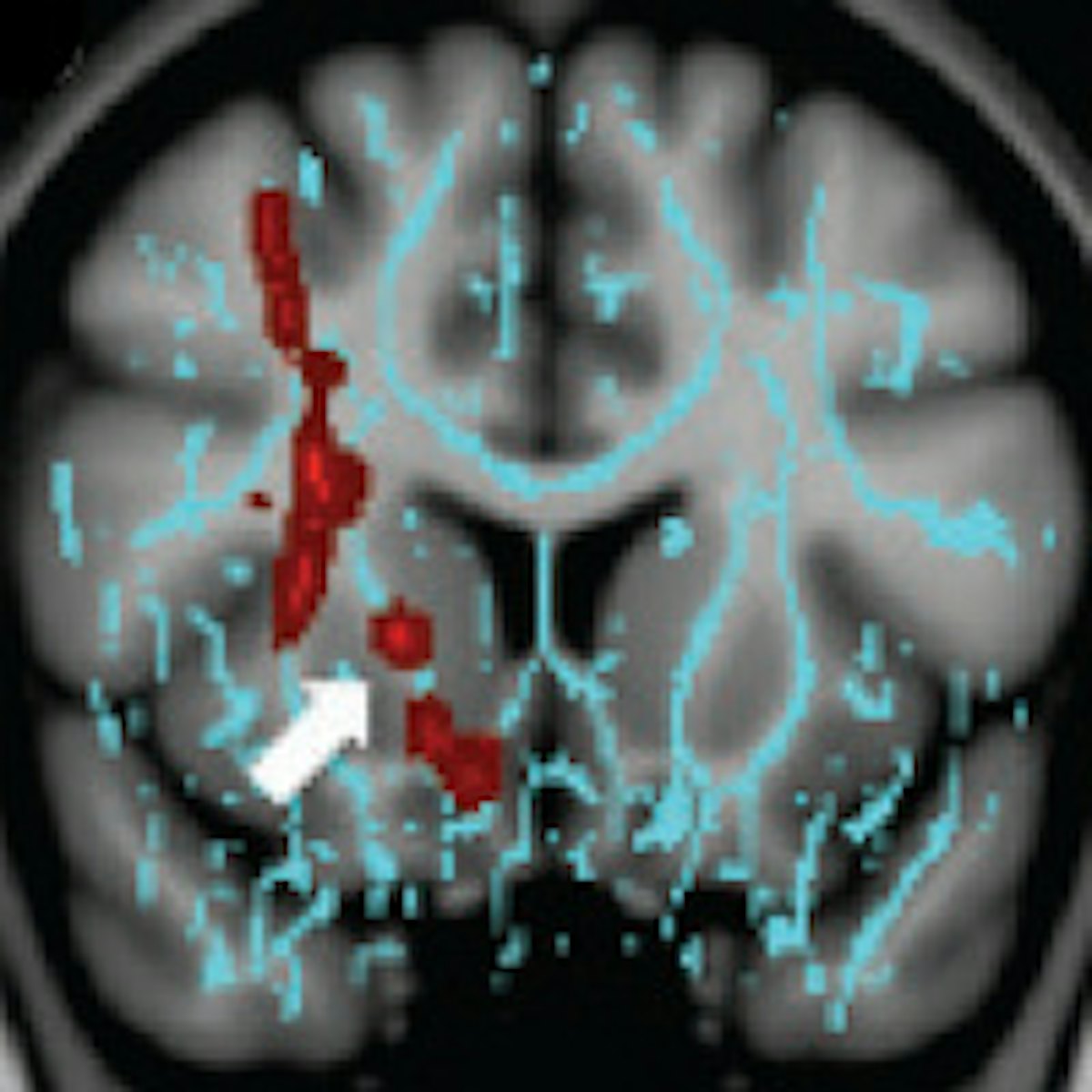 DTI-MRI sheds light on concussion symptoms | AuntMinnie