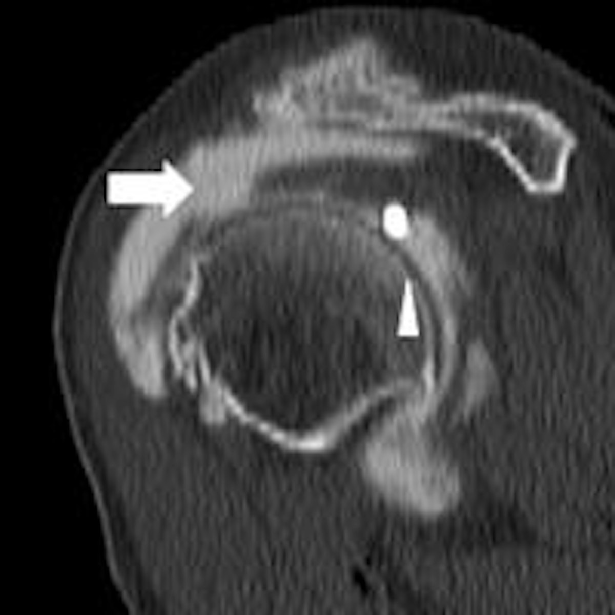 mri shoulder cpt code
