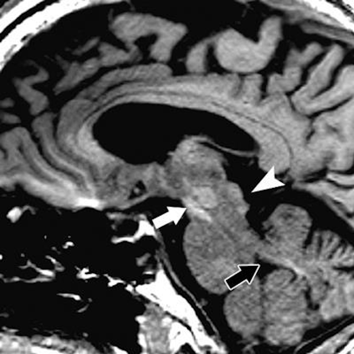 Study finds gadolinium hot spots, but no clinical effects | AuntMinnie
