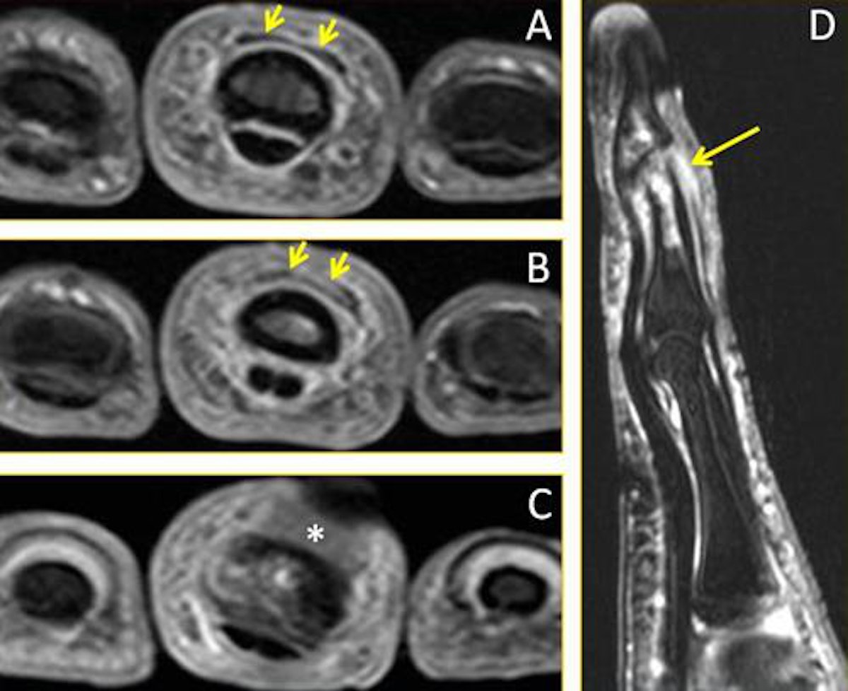extensor tendon finger mri