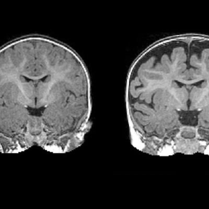 MRI Links Early Brain Abnormality In Infants To Autism AuntMinnie mri-links-early-brain-abnormality-in-infants-to-autism-auntminnie