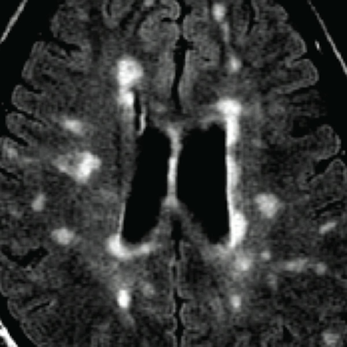 SIR: MRI debunks venoplasty for treating MS | AuntMinnie