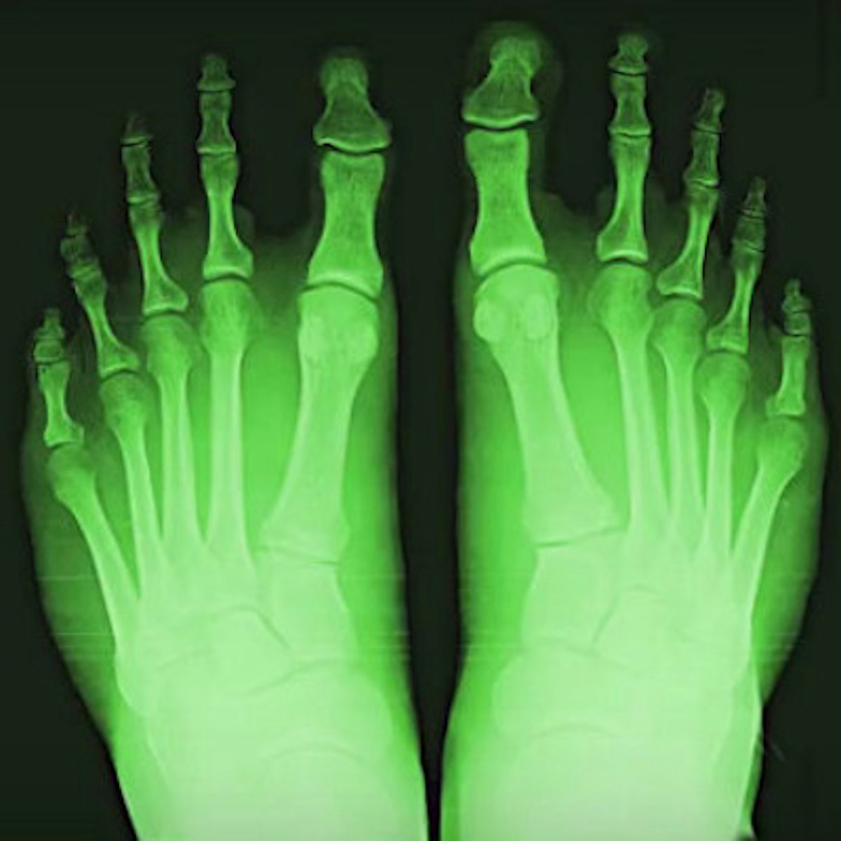 FDA reviews history of 'shoe-fitting fluoroscope' | AuntMinnie