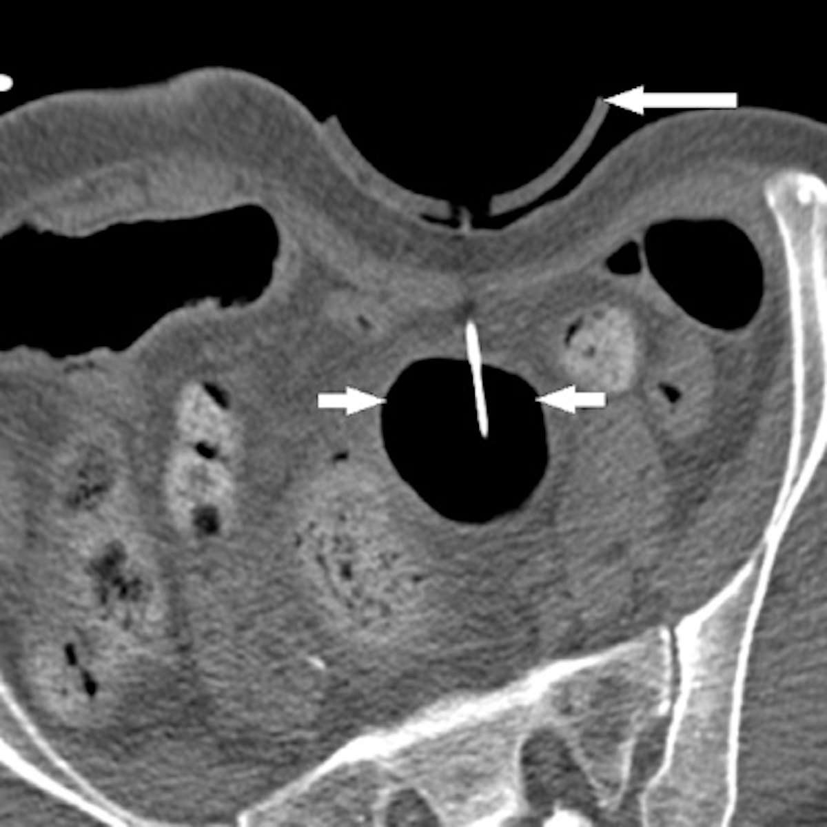 3D printing helps rads build better CT fluoro paddle | AuntMinnie