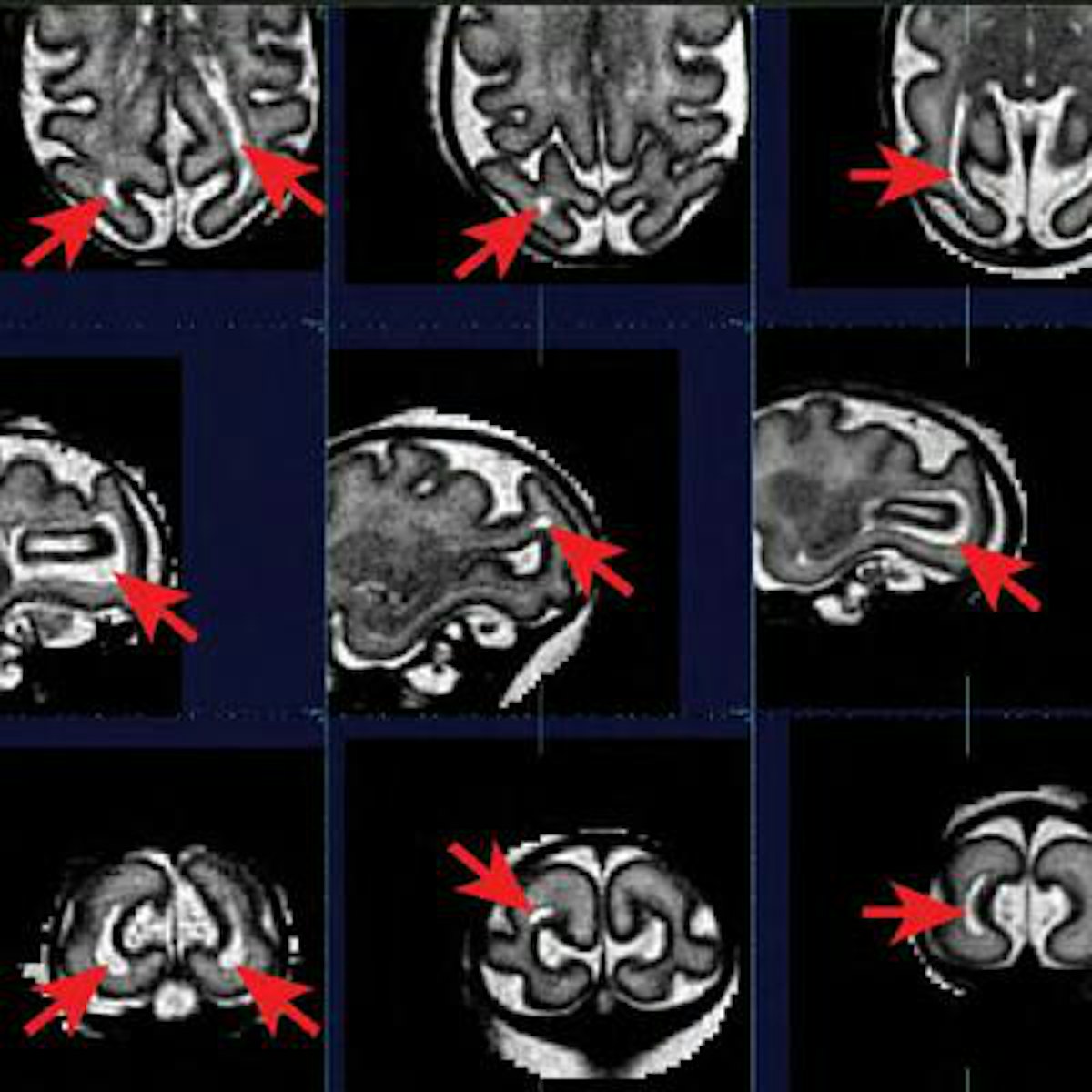 Zika's effects hard to detect on ultrasound, MRI | AuntMinnie