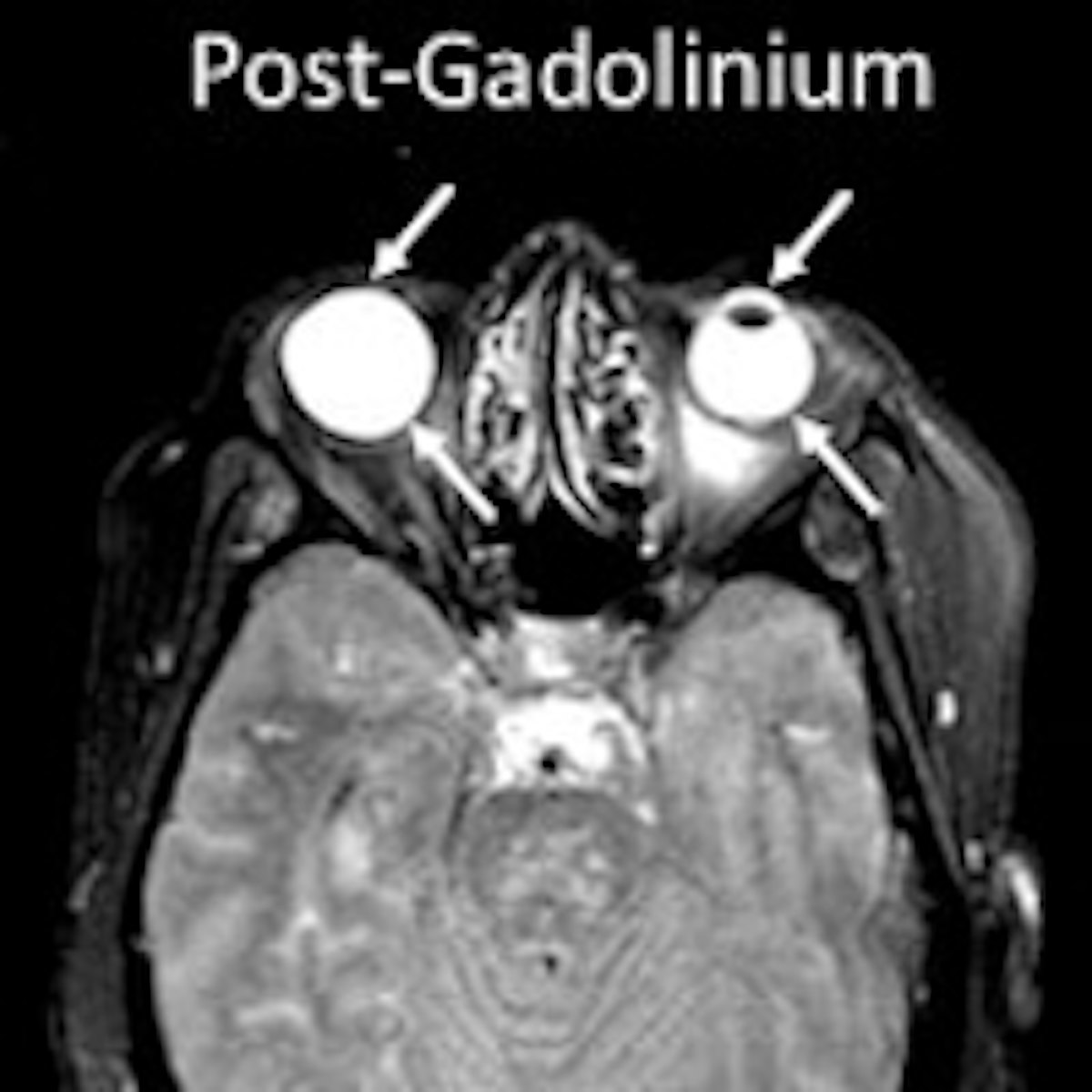 gadolinium side effects