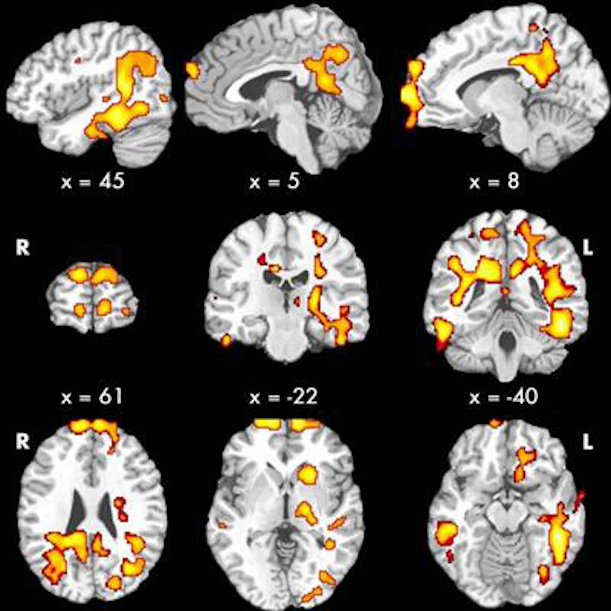 ASL-MRI connects kidney and cognitive dysfunction | AuntMinnie