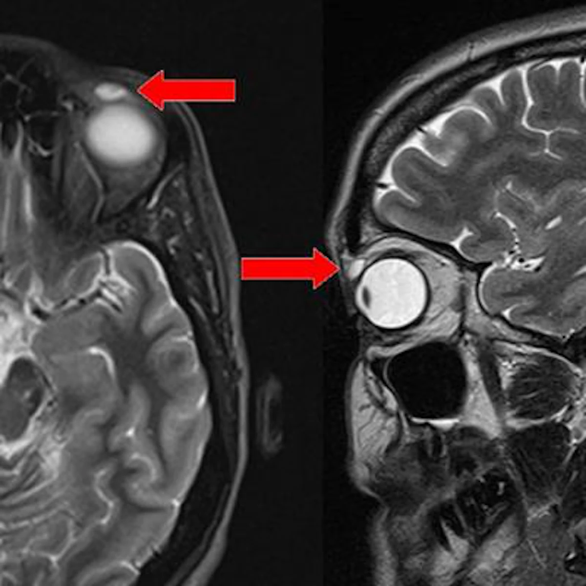 MRI helps find contact lens embedded in eye for 28 years | AuntMinnie