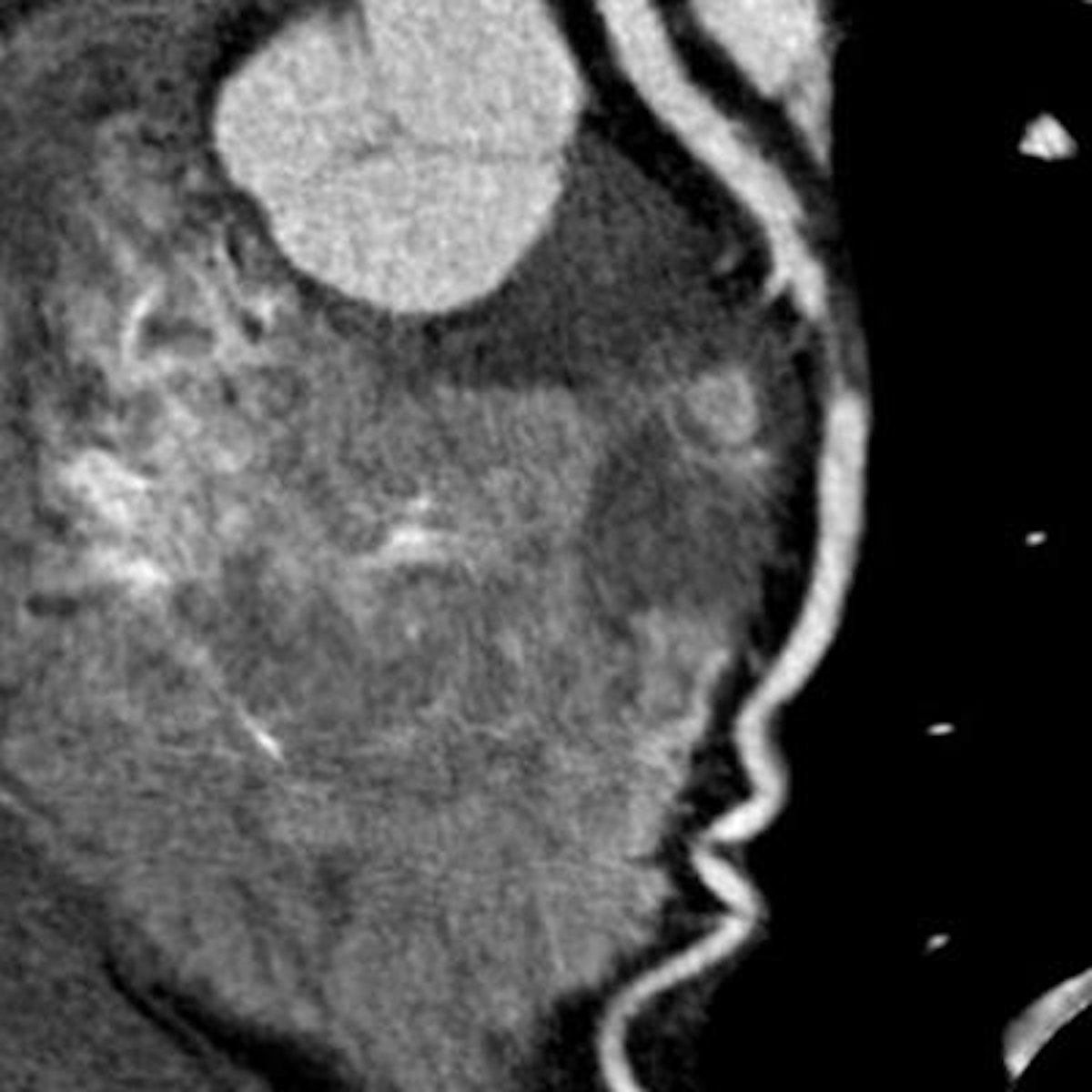 5 reasons why CCTA should be a first-line test for CAD | AuntMinnie