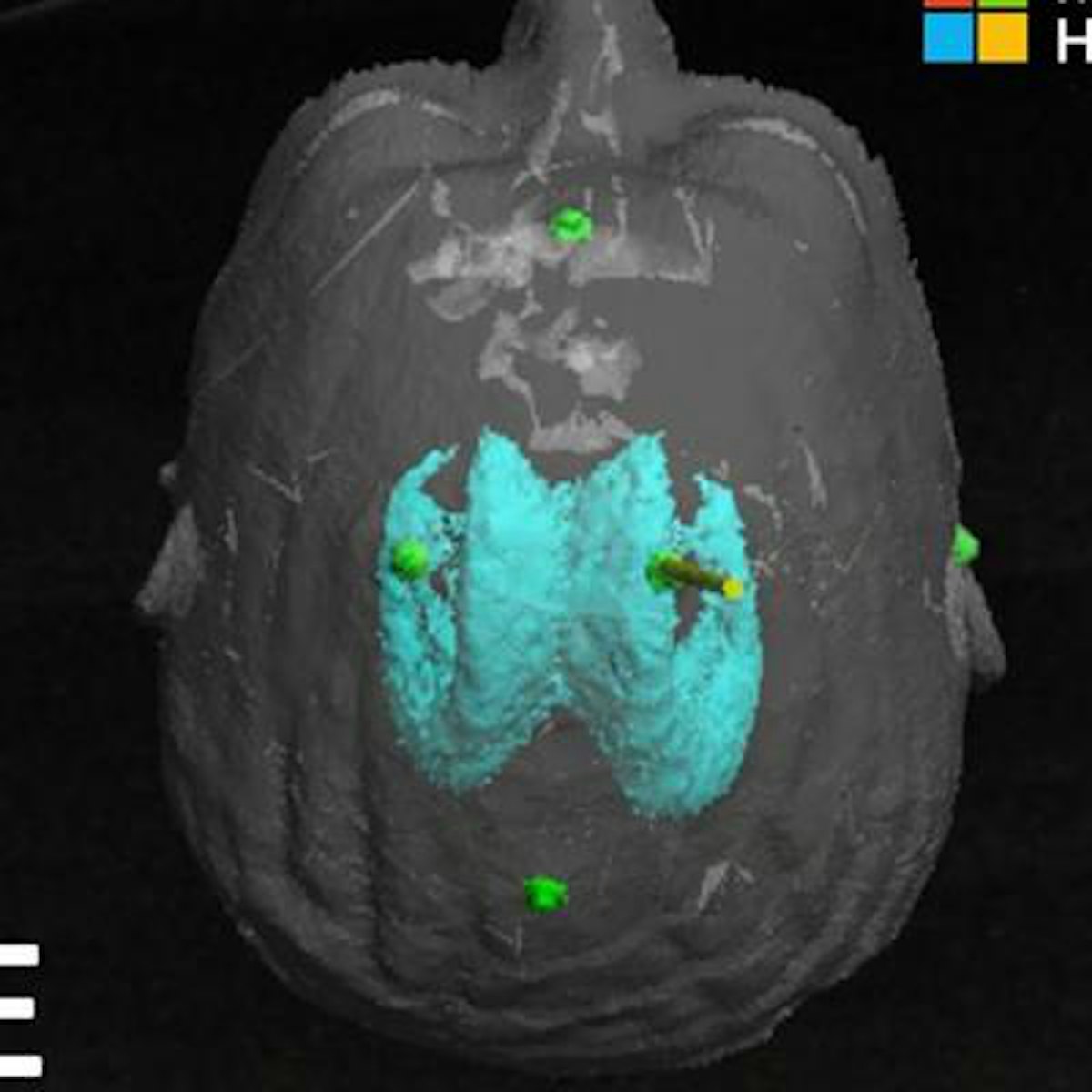 Augmented reality heightens accuracy of brain procedure | AuntMinnie