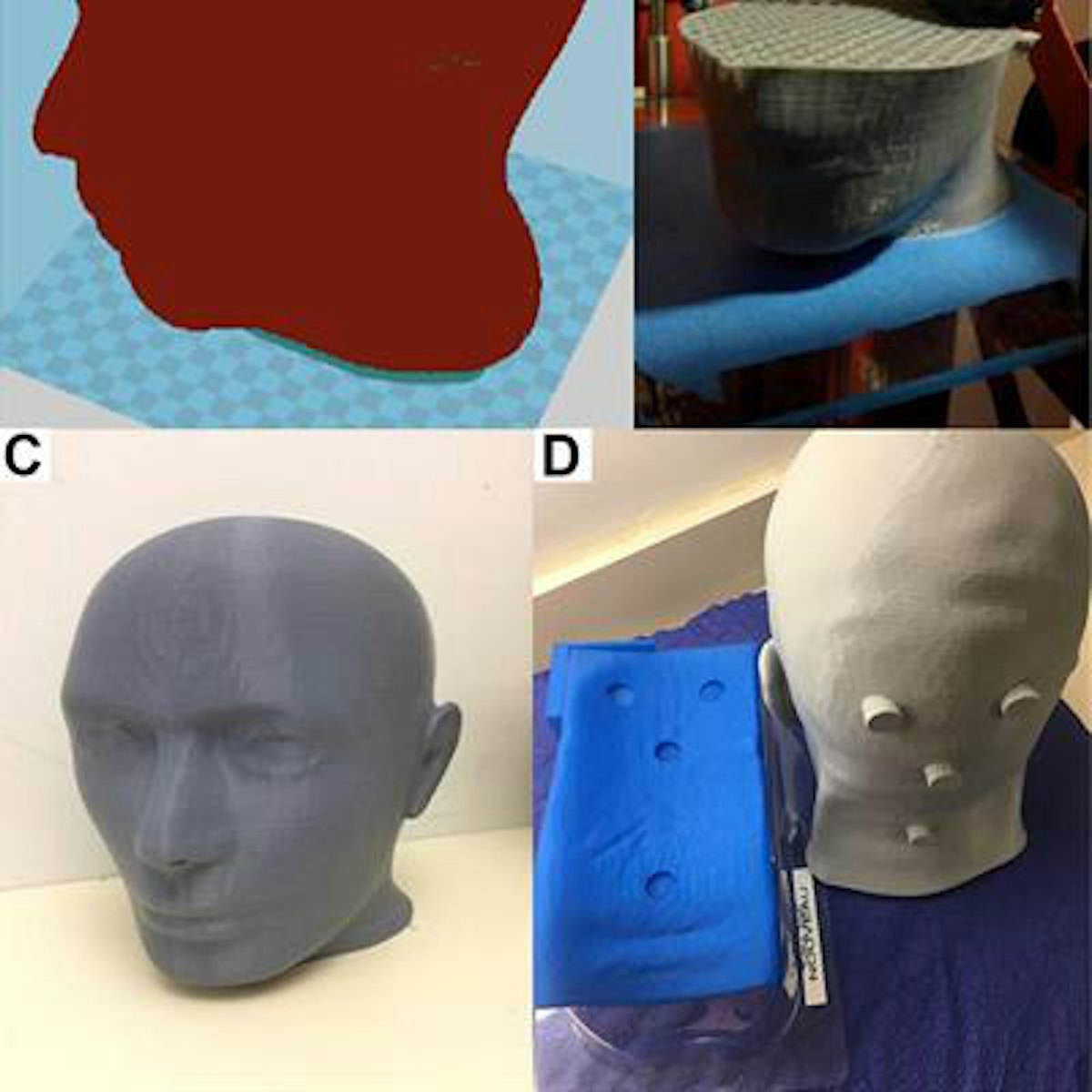 3D head models reduce workload for brain radiotherapy | AuntMinnie