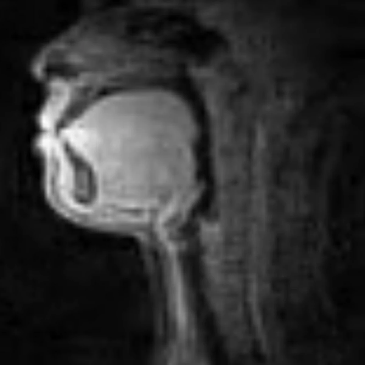 MRI reveals mechanics of beatboxing | AuntMinnie