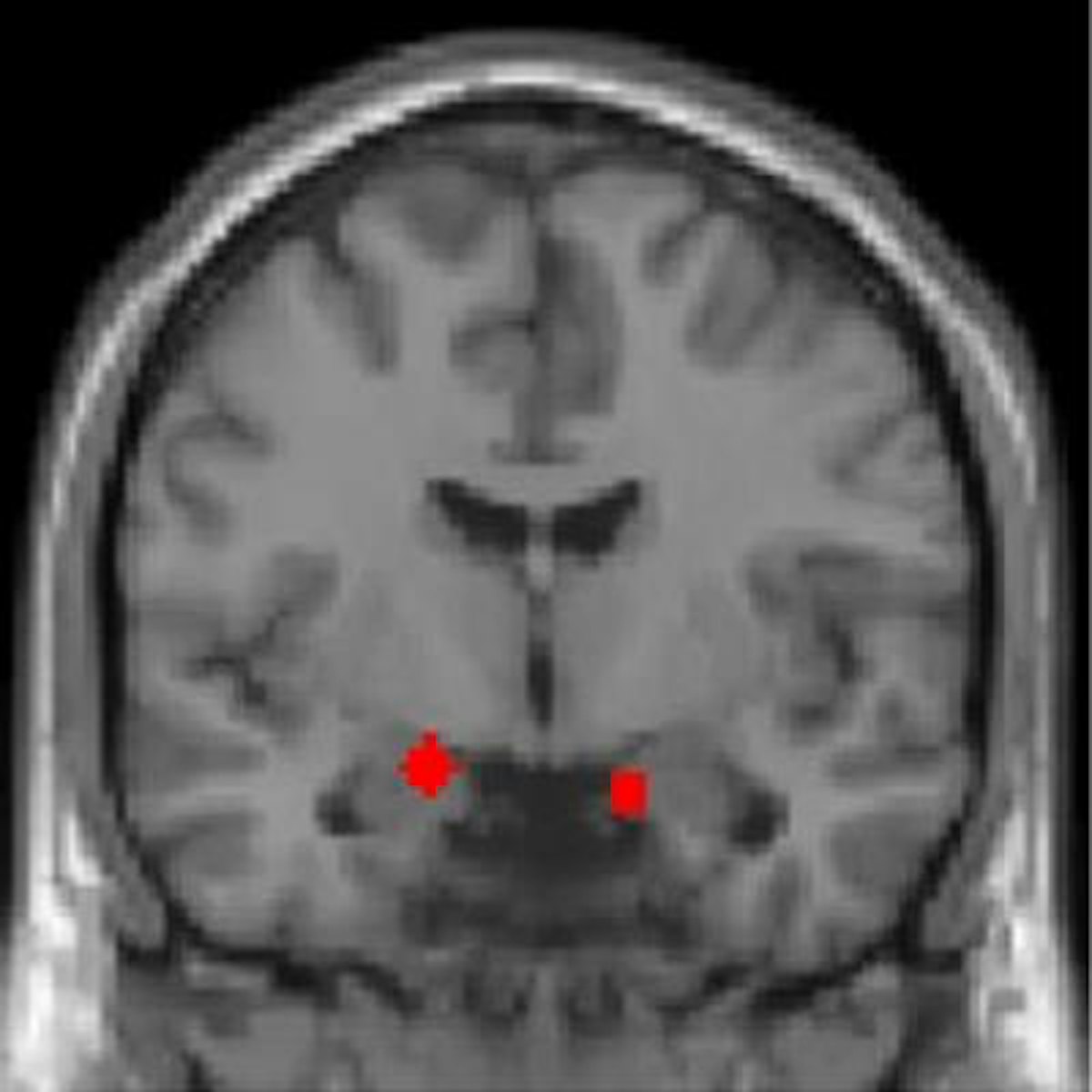 fMRI helps finds brain biomarkers linked to severe PTSD | AuntMinnie