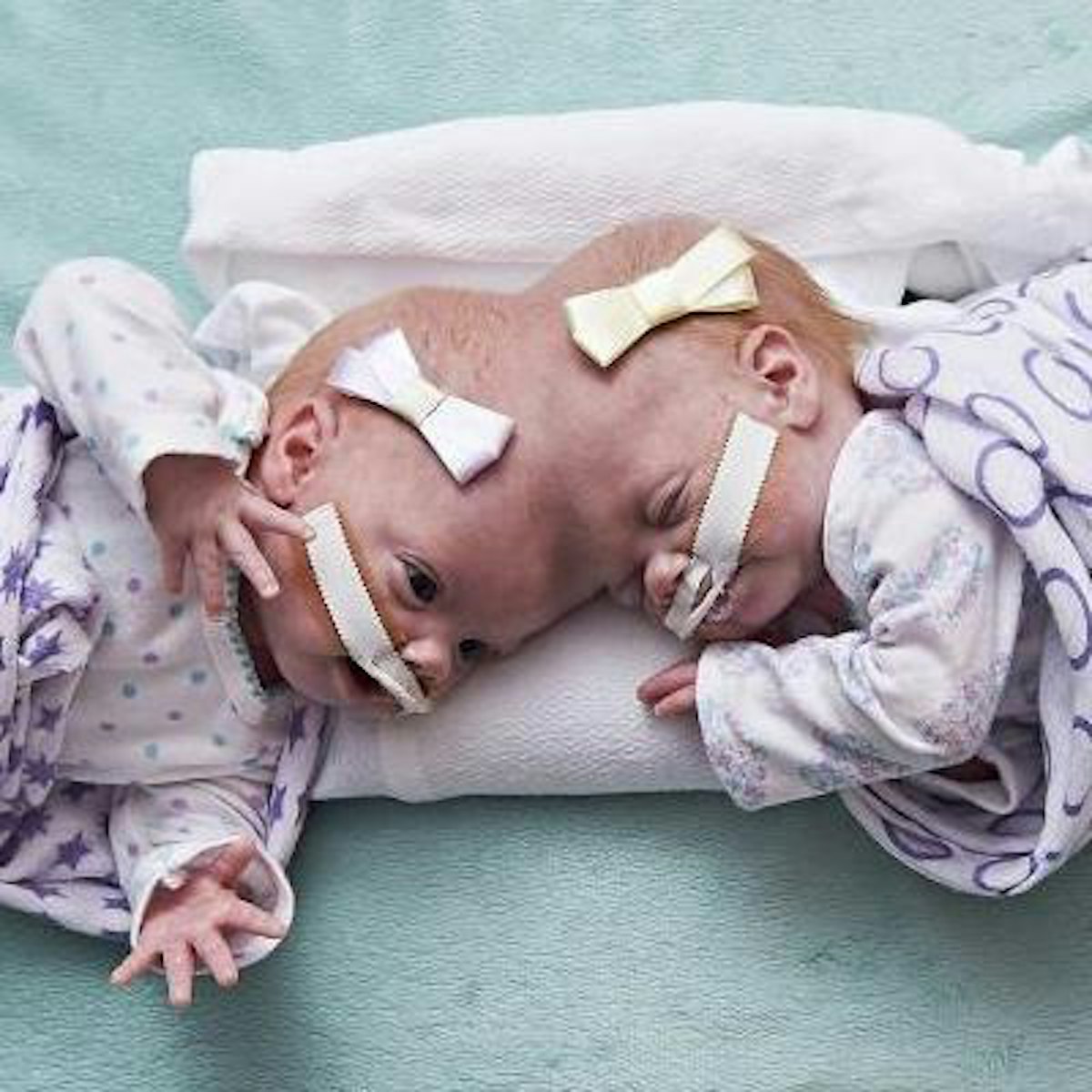 3D printing helps separate rare case of conjoined twins | AuntMinnie