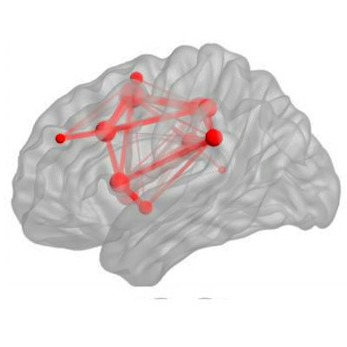 fMRI links imaging biomarker to PTSD treatment response | AuntMinnie
