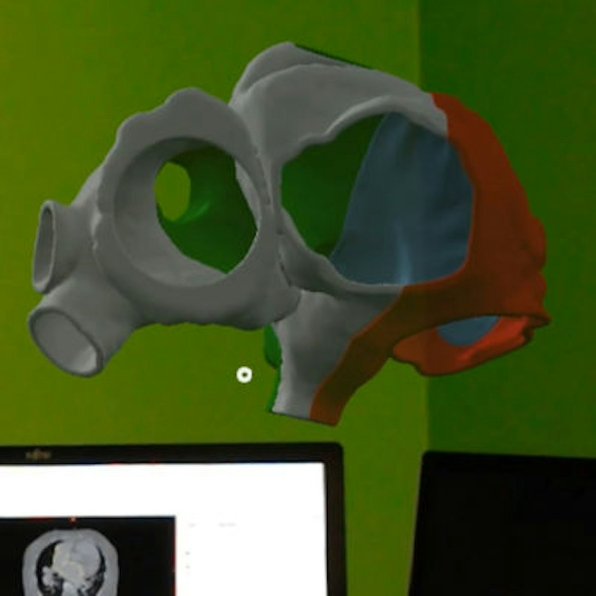 AR, 3D printing enhance planning for complex heart surgery | AuntMinnie