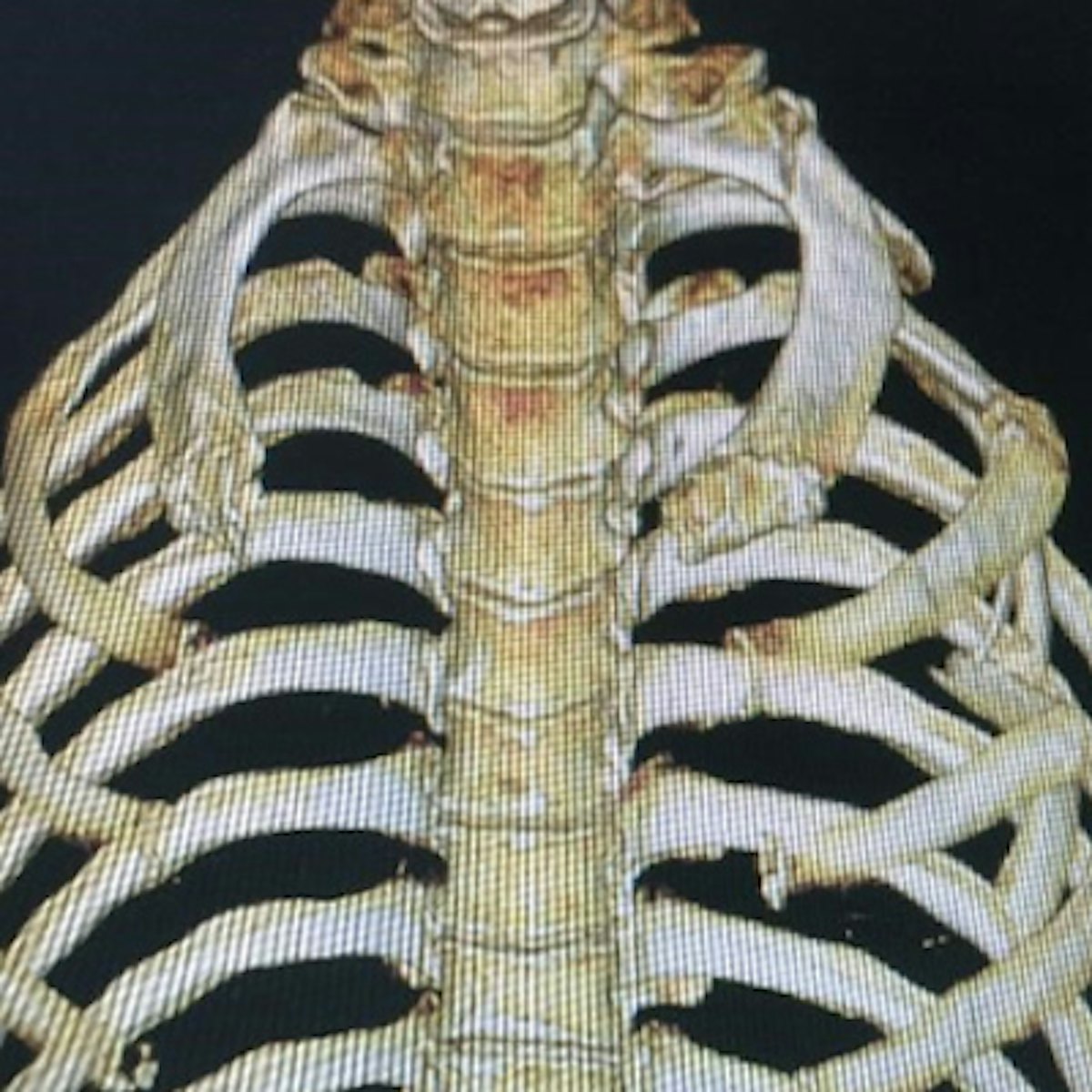 3D printing bolsters surgery for multiple rib fractures | AuntMinnie