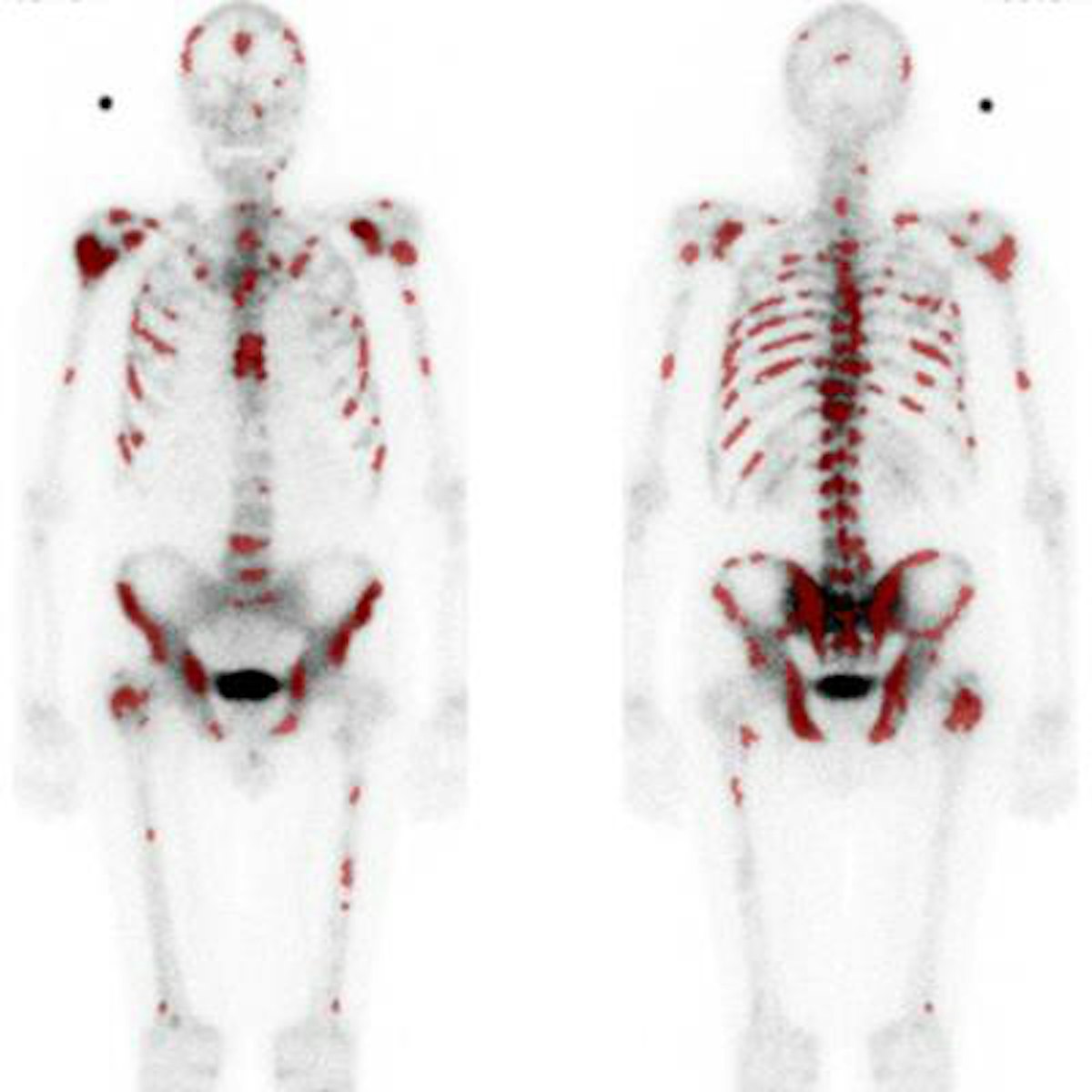 Automated bone scan software proves worth with radium-223 | AuntMinnie