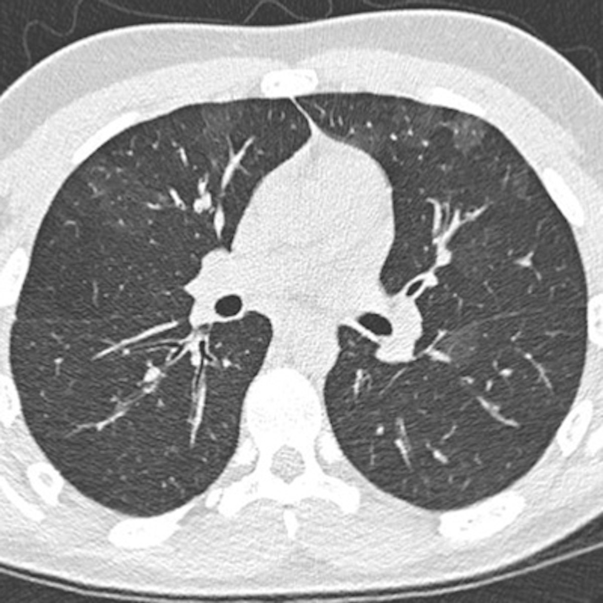 CT highlights risk of lung inflammation from vaping | AuntMinnie