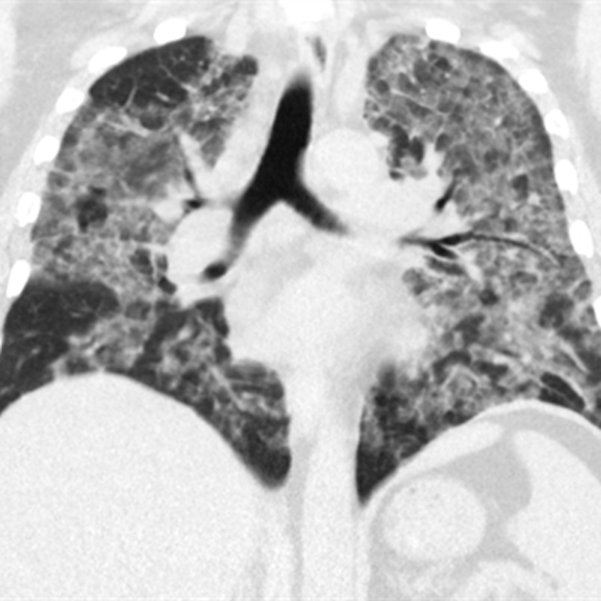 Imaging experts give insight on vaping-related lung injury | AuntMinnie