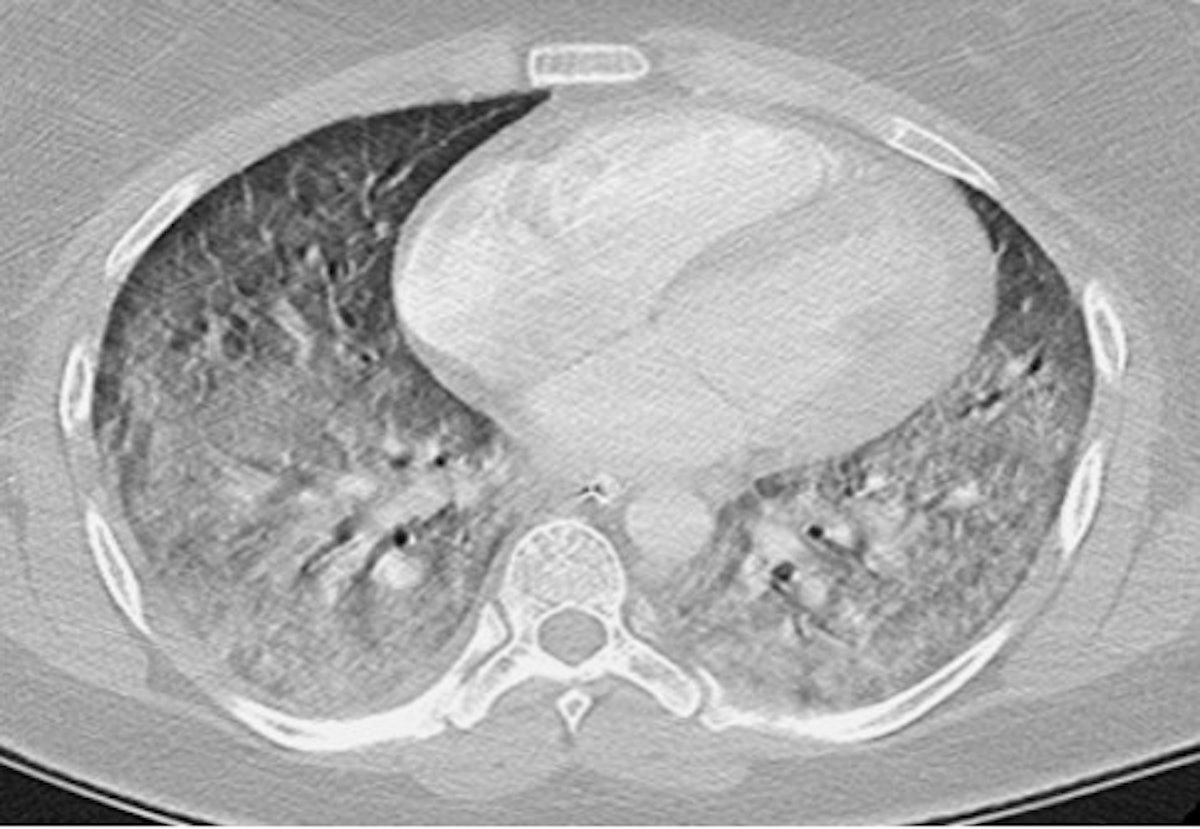 ards lungs ct