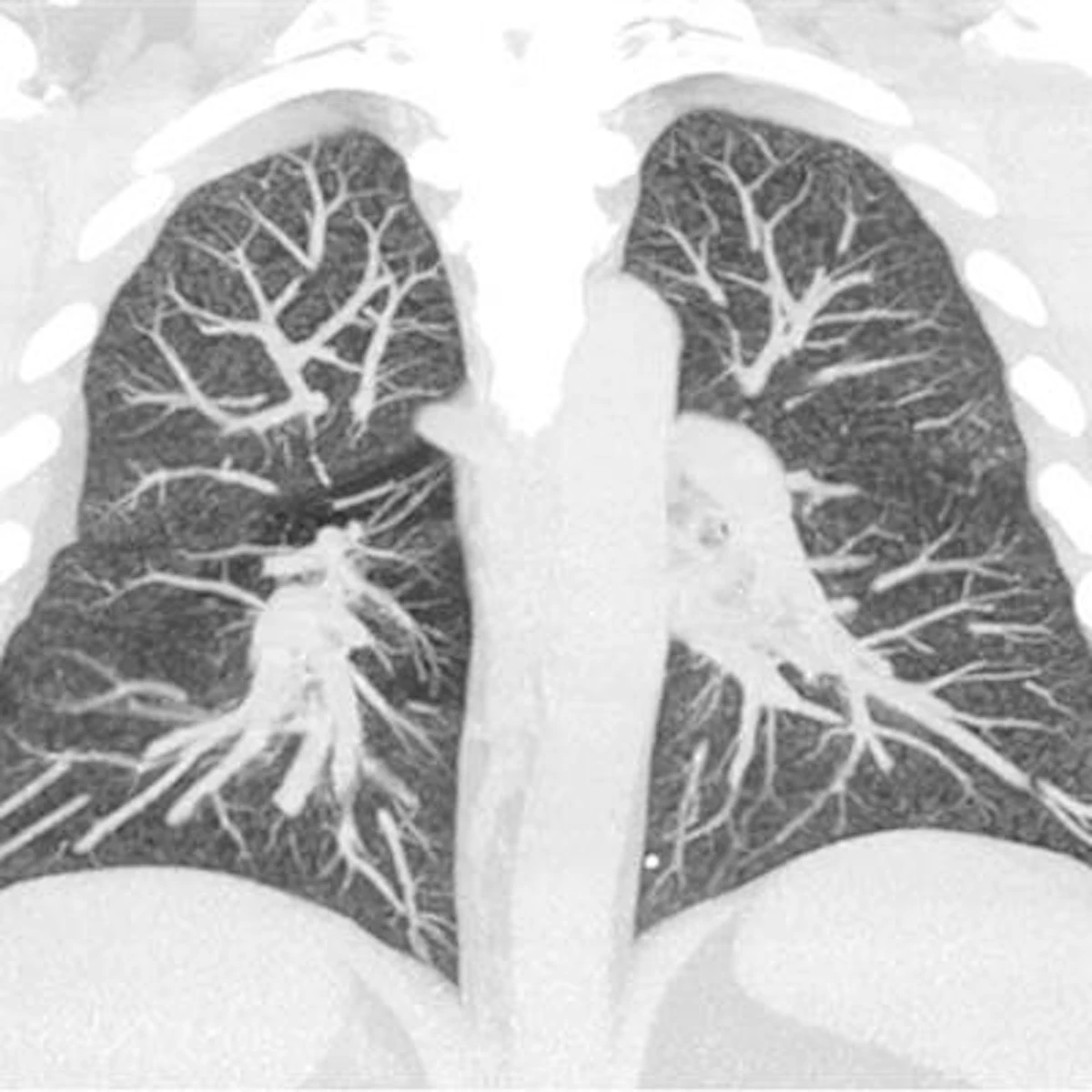 Experts reemphasize value of imaging in EVALI diagnosis | AuntMinnie