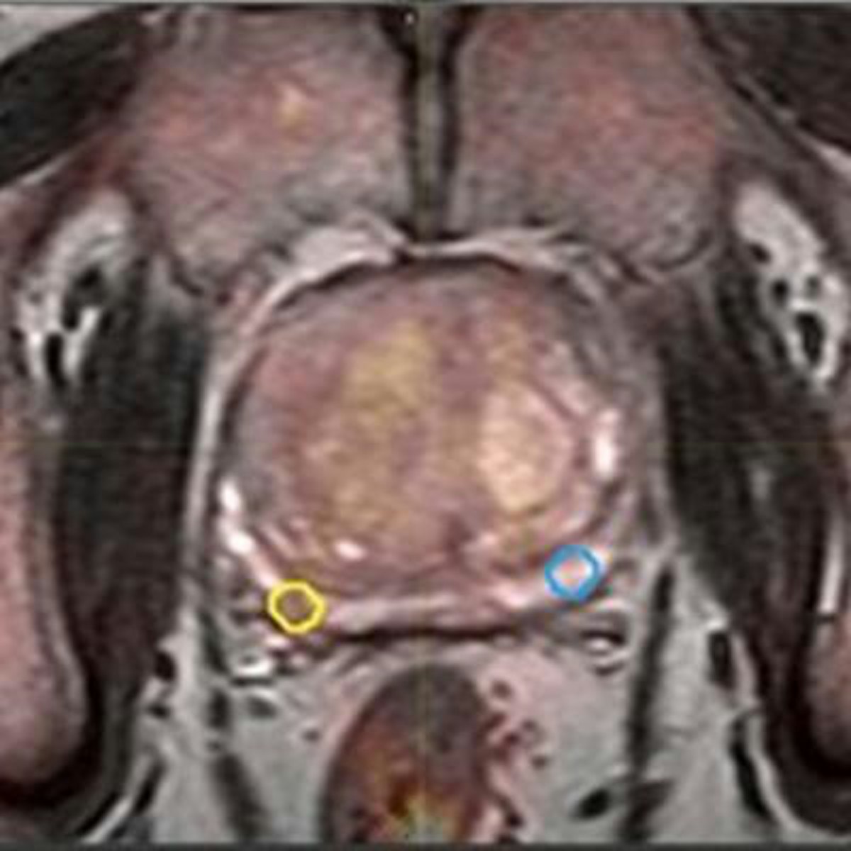 Choline-PET boosts mpMRI for prostate cancer detection | AuntMinnie