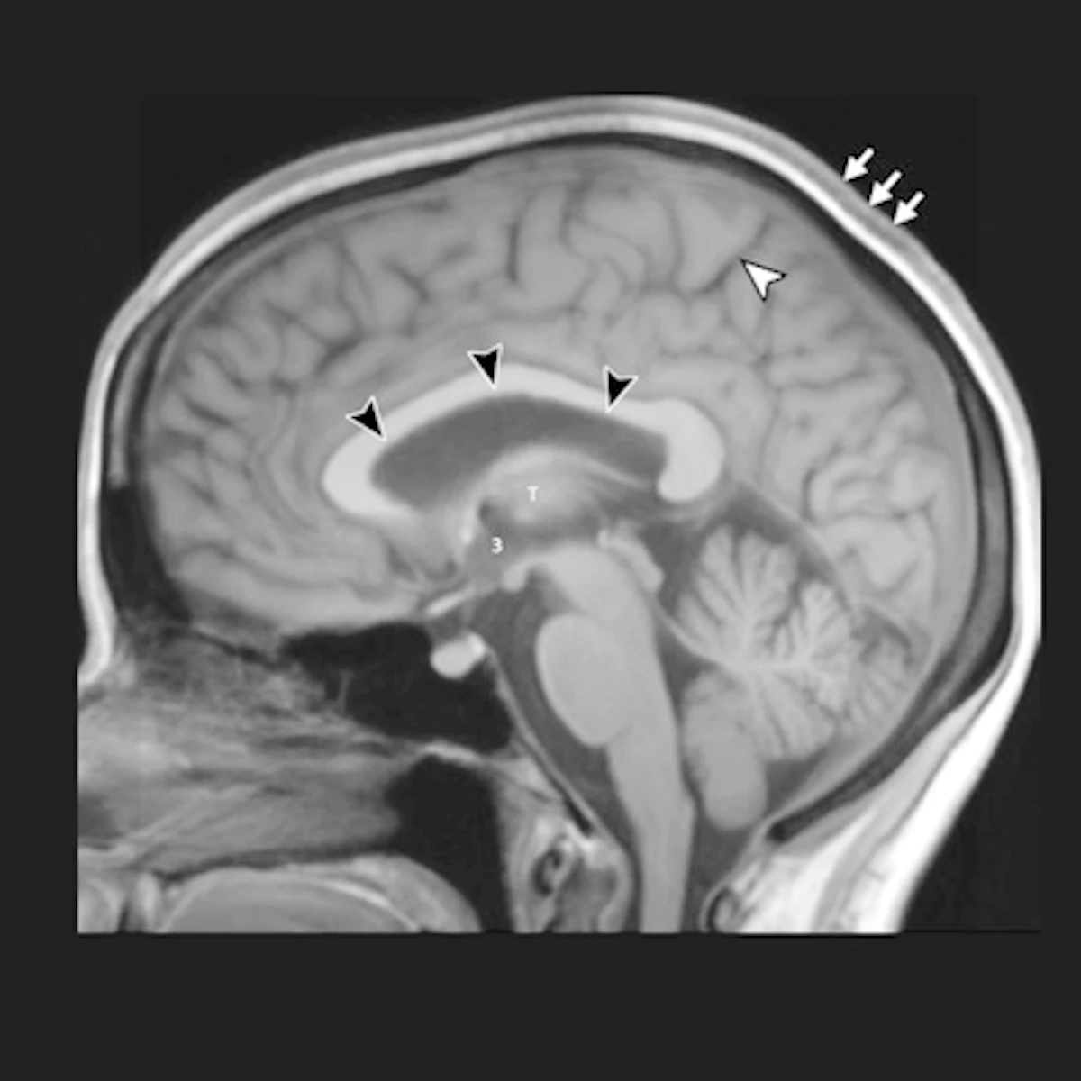 MRI shows brain changes in astronauts after time in space | AuntMinnie