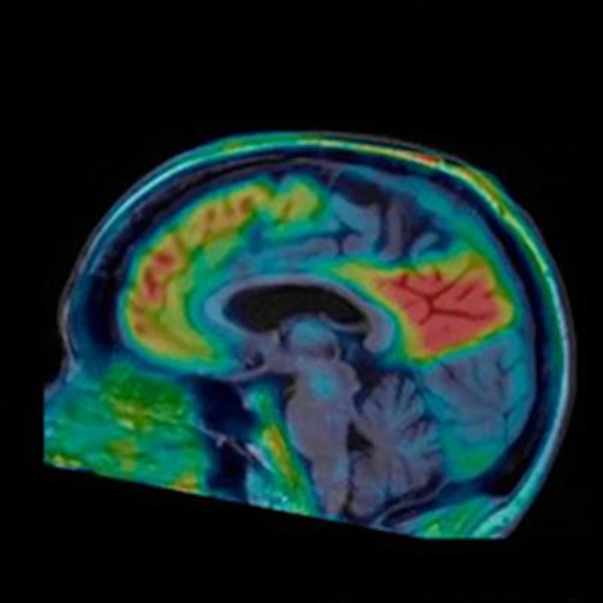New tau PET tracer better targets source of Alzheimer's | AuntMinnie