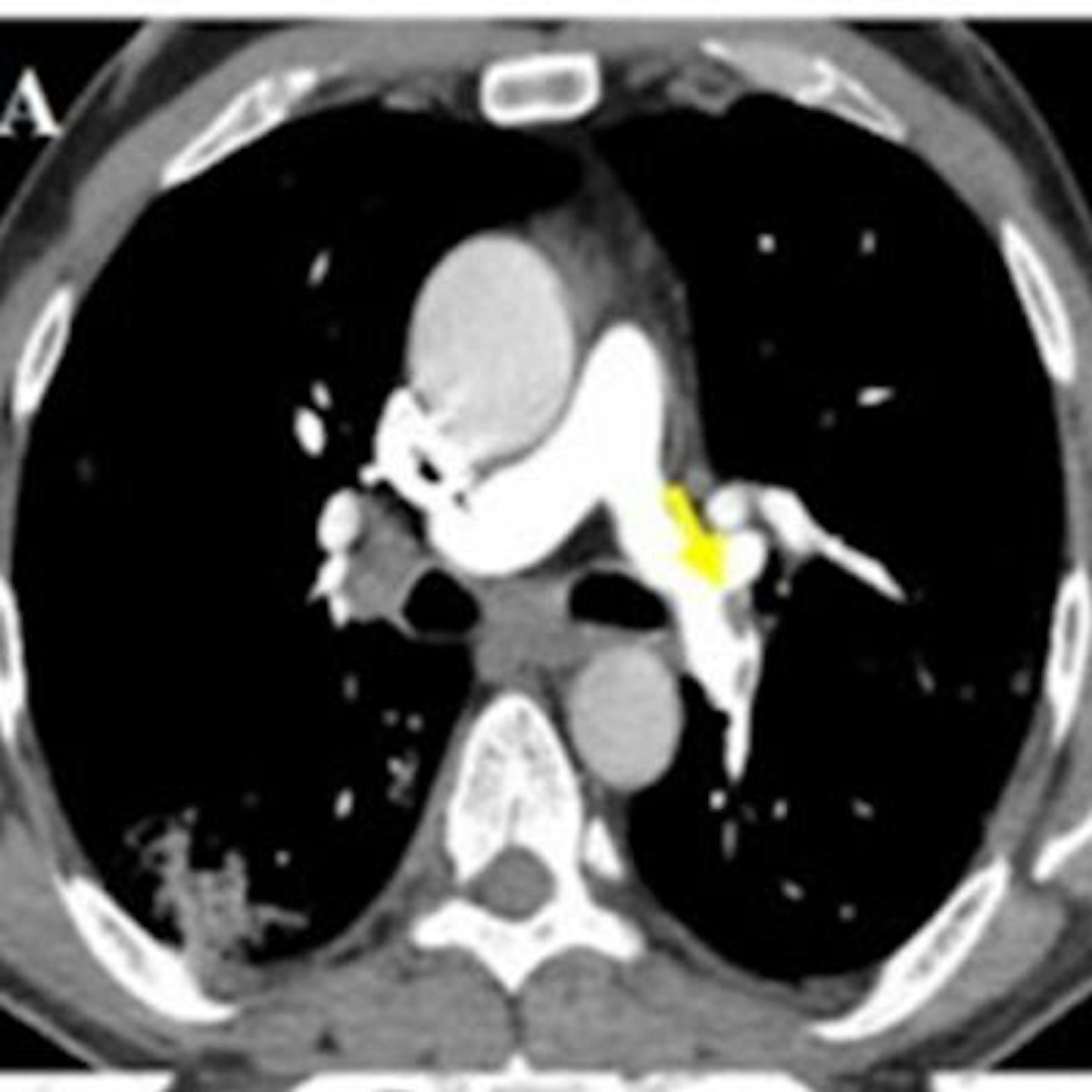What causes PTE in COVID-19 patients? | AuntMinnie